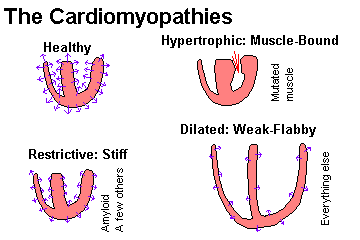 Restrictive Cardiomyopathy - Smarty PANCE