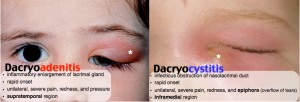 Dacryoadenitis - Smarty PANCE