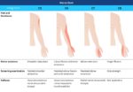 Radiculopathy Rapid Review: Cervical and Lumbar Patterns - Smarty PANCE