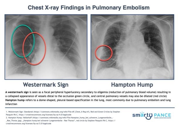 Pulmonary Circulation (PEARLS) | Pulmonary System - Smarty PANCE