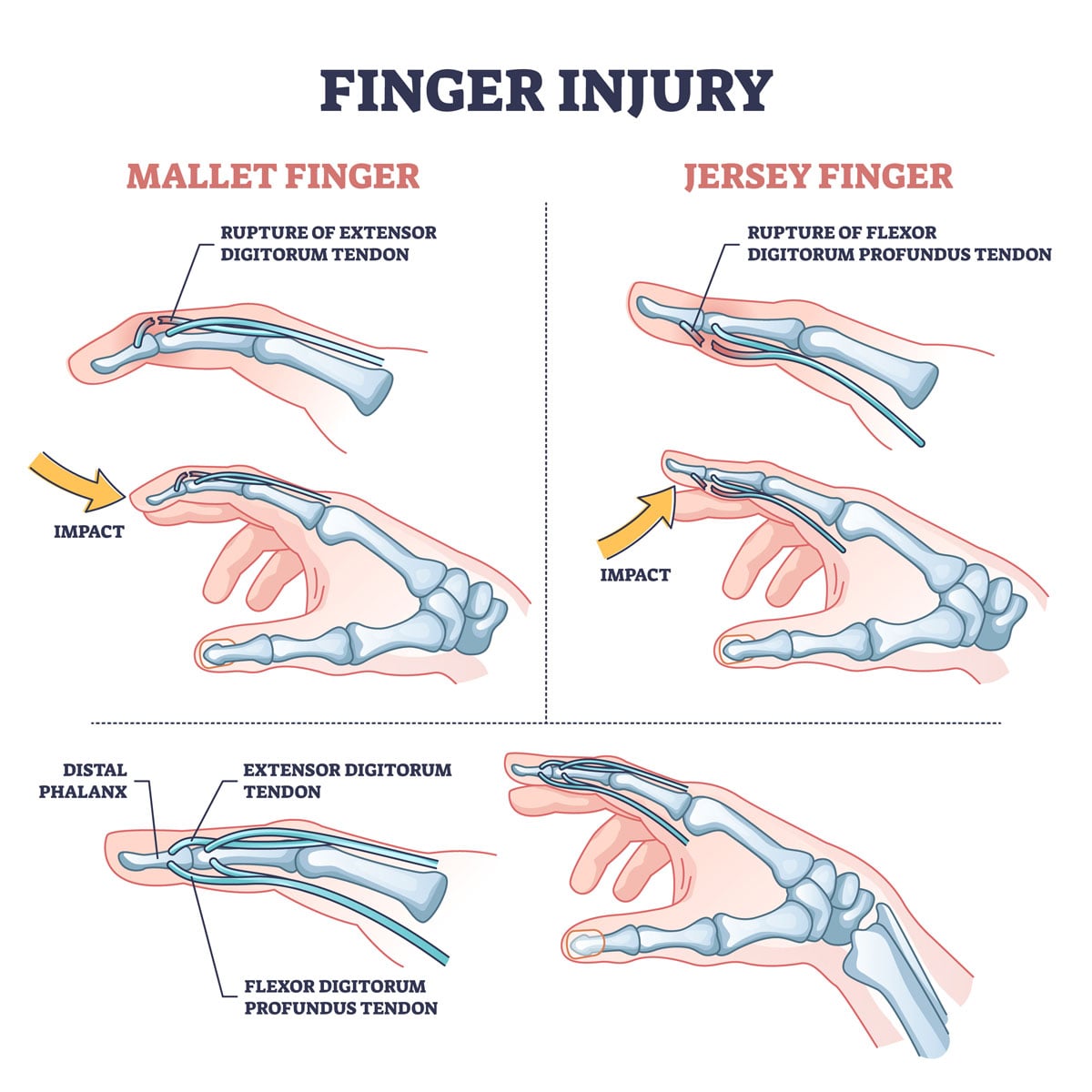 Upper Extremity Disorders (Soft Tissue Injuries): The Daily PANCE ...