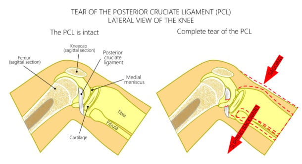Soft Tissue Injuries of the Knee (ReelDx) | Musculoskeletal Blueprint ...