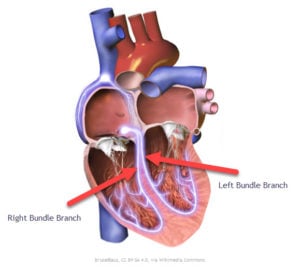 Bundle Branch Block | Cardiology Content Blueprint - Smarty PANCE