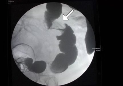 Colon cancer (Lecture) - Smarty PANCE