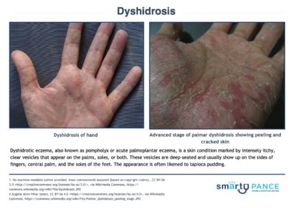 Eczematous Eruptions (PEARLS) - Smarty PANCE