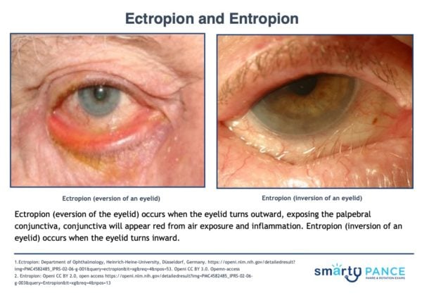 Entropion | PANCE | PANRE - EENT Content Blueprint - Smarty PANCE