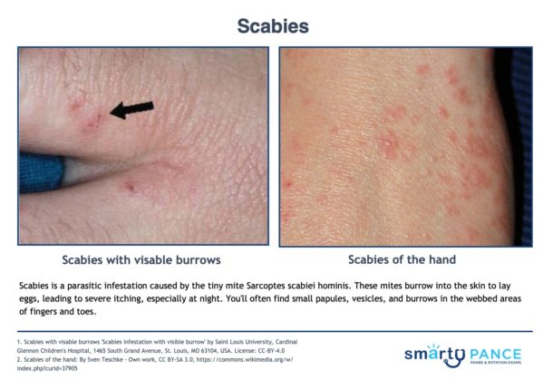 Emergency Medicine Rotation: Dermatology (PEARLS) - Smarty PANCE