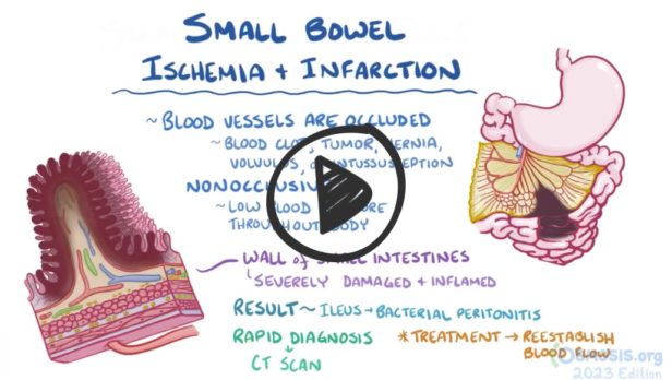 Ischemic bowel disease - Smarty PANCE