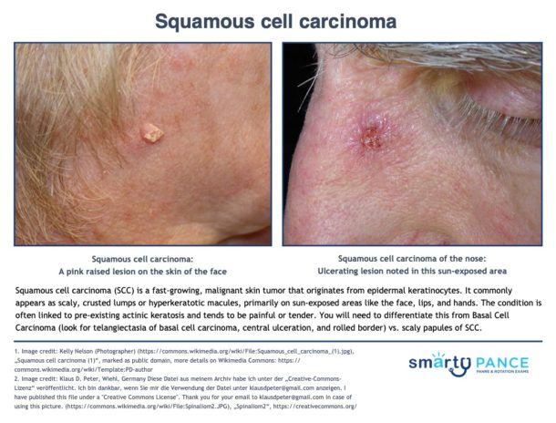 General Surgery: Dermatology (PEARLS) - Smarty PANCE