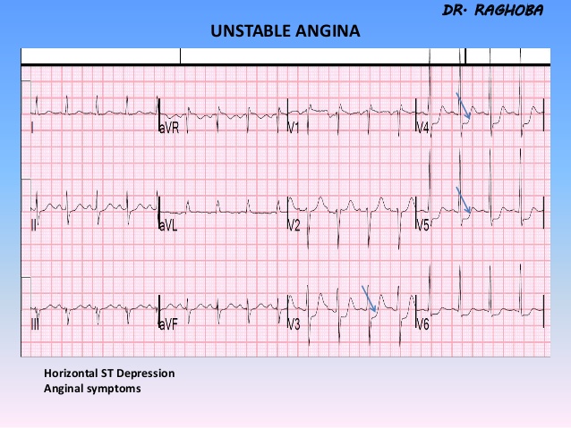 Unstable angina | SMARTY PANCE