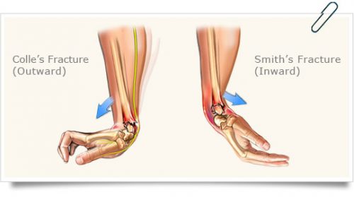 Upper extremity disorders (PEARLS) - Smarty PANCE