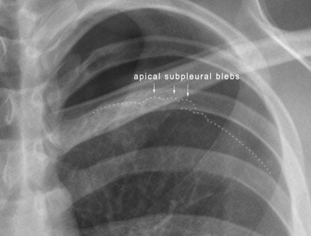 Chronic obstructive pulmonary diseases (PEARLS + Lecture) - Smarty PANCE