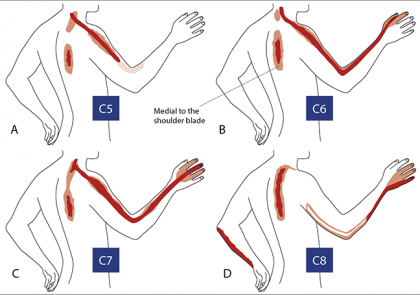 Radiculopathy Rapid Review: Cervical and Lumbar Patterns - Smarty PANCE