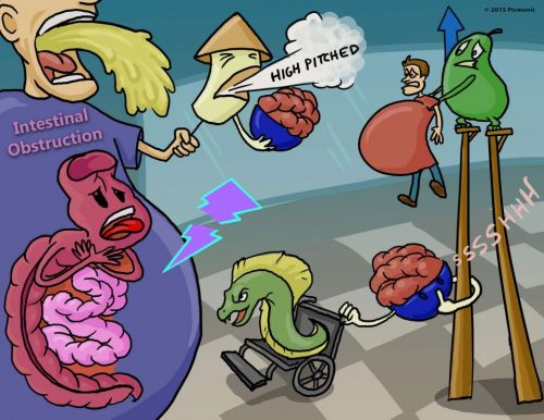 Small bowel obstruction (ReelDx) - Smarty PANCE