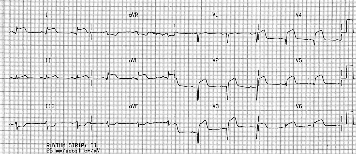 Myocardial Infarction: The Daily PANCE Blueprint - Smarty PANCE