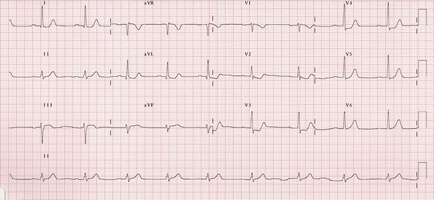 Myocardial Infarction: The Daily PANCE Blueprint - Smarty PANCE
