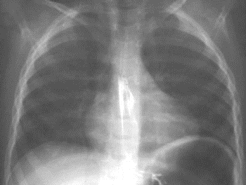 Congenital Heart Disease PEARLS | Cardiology System - Smarty PANCE