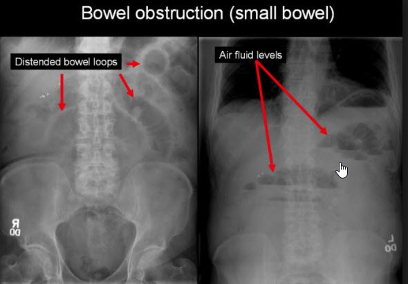 Small bowel obstruction (ReelDx) - Smarty PANCE