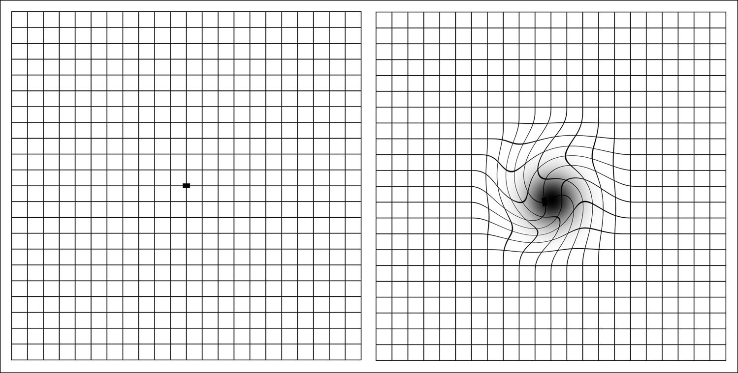 Macular Degeneration EENT PANCE Content Blueprint SMARTY PANCE