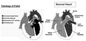 Tetraology of Fallot | Cardiology System Blueprint - Smarty PANCE