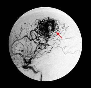 Arteriovenous Malformations | Cardiology System Blueprint - Smarty PANCE