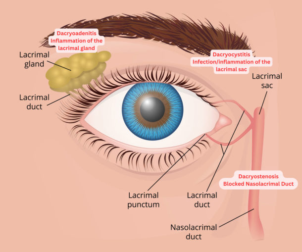 Dacryoadenitis and Dacryocystitis - Smarty PANCE