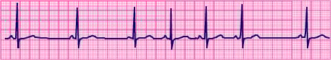 Sinus Arrhythmia | Cardiology System Blueprint - Smarty PANCE