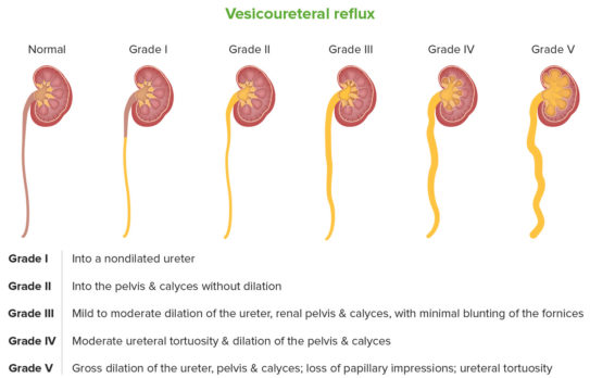 Vesicoureteral reflux - Smarty PANCE