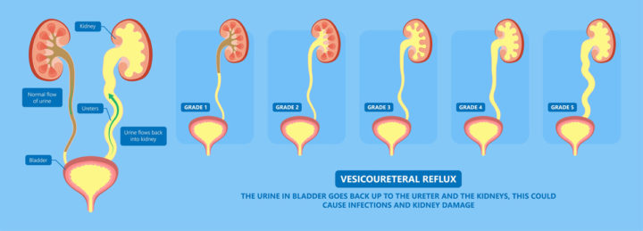 Vesicoureteral reflux - Smarty PANCE