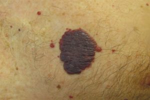Cherry Angioma | Dermatology System Blueprint - Smarty PANCE