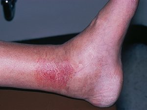 Stasis dermatitis - Smarty PANCE