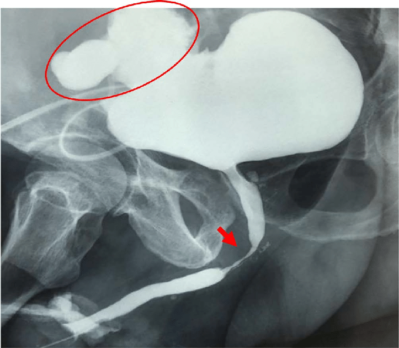 Urethral Stricture | Genitourinary Sytsem Blueprint - Smarty PANCE
