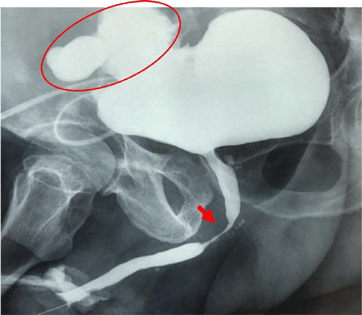 Urethral disorders (PEARLS) - Smarty PANCE