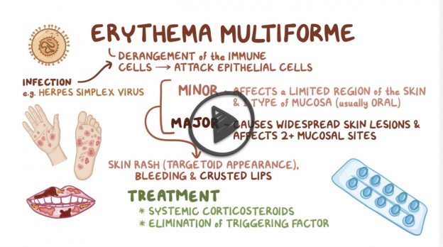 Erythema multiforme (ReelDx) - Smarty PANCE