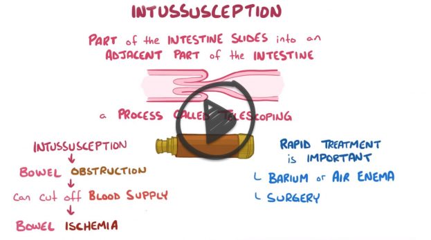 Intussusception (ReelDx) - Smarty PANCE
