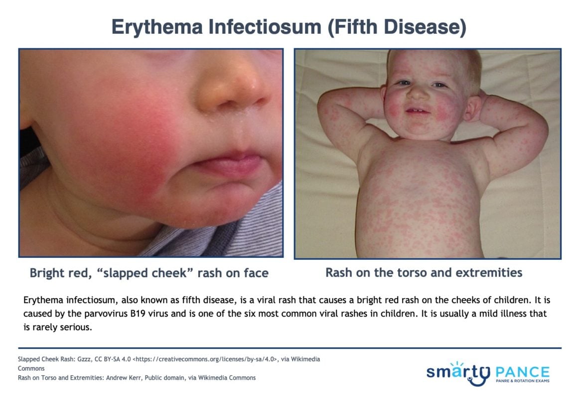 Pediatric EOR: Infectious Disease (Pearls) - Smarty PANCE