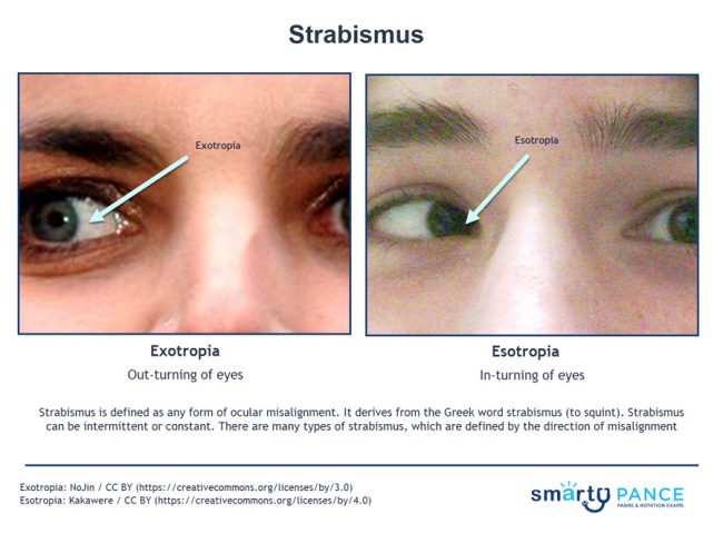 Vision abnormalities (PEARLS) - Smarty PANCE
