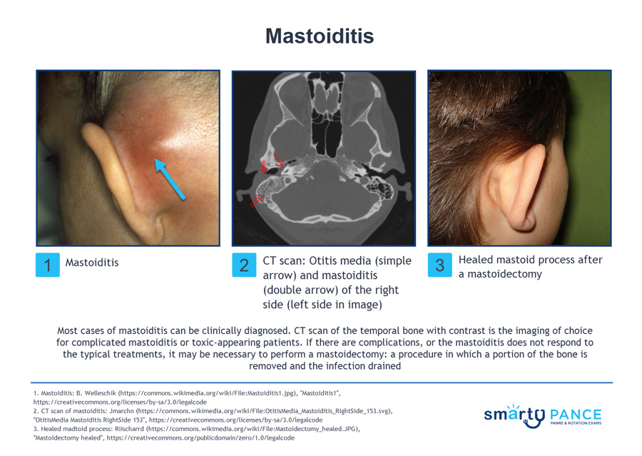 Mastoiditis