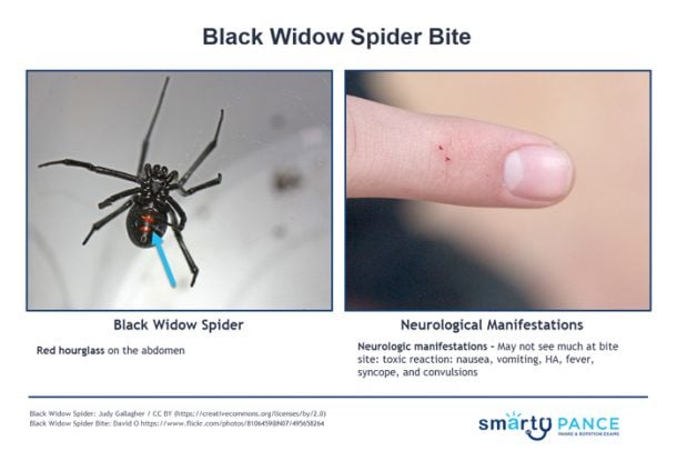 PANCE Blueprint Showdown: Black Widow vs. Brown Recluse Spider Bites ...