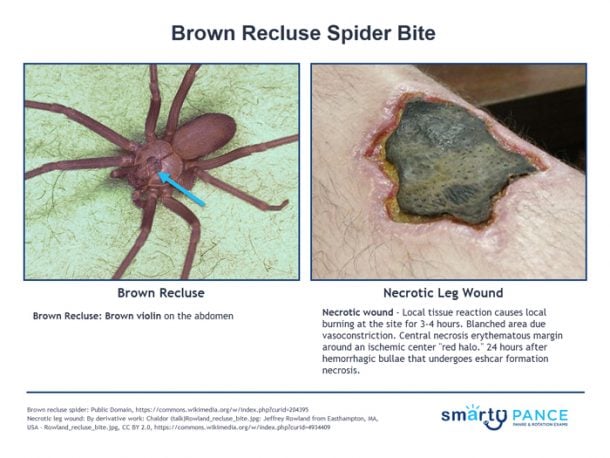 PANCE Blueprint Showdown: Black Widow vs. Brown Recluse Spider Bites ...