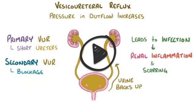Vesicoureteral reflux - Smarty PANCE