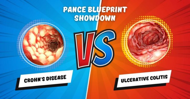 PANCE Blueprint Showdown: Crohn's Disease vs. Ulcerative Colitis ...