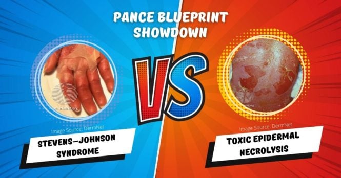 PANCE Blueprint Showdown: Stevens-Johnson syndrome (SJS) vs. Toxic ...