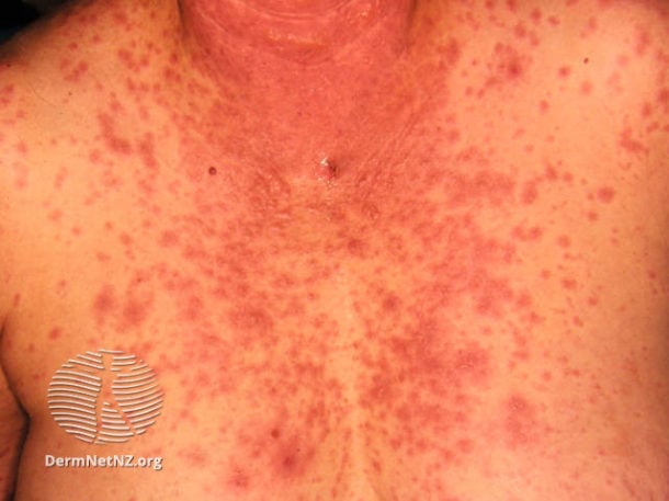 PANCE Blueprint Showdown: Stevens-Johnson syndrome (SJS) vs. Toxic ...