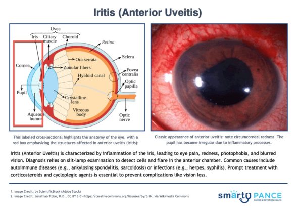 Inflammatory disorders (PEARLS) - Smarty PANCE