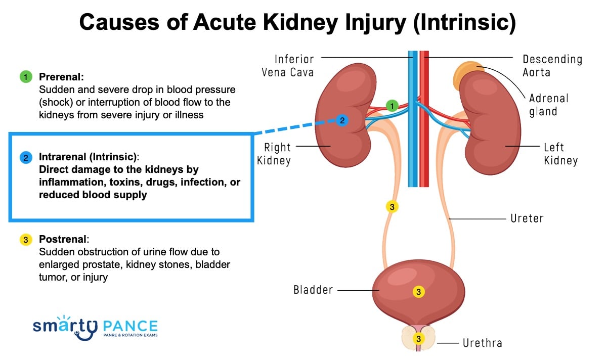 Intrinsic (Renal) acute kidney injury (AKI) - Smarty PANCE