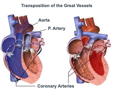 Congenital Heart Disease PEARLS | Cardiology System - Smarty PANCE